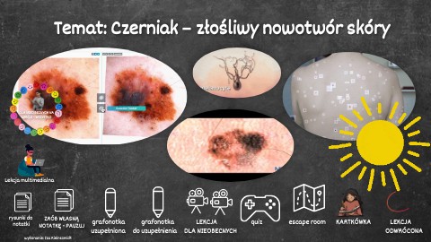 sp - 6. Czerniak - złośliwy nowotwór skóry sp - 6. Czerniak - złośliwy nowotwór skóry