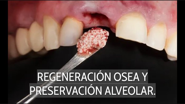 REGENERACION OSEA Y PRESERVACION ALVEOLAR
