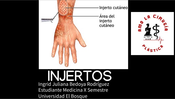 GENERALIDADES DE INJERTOS