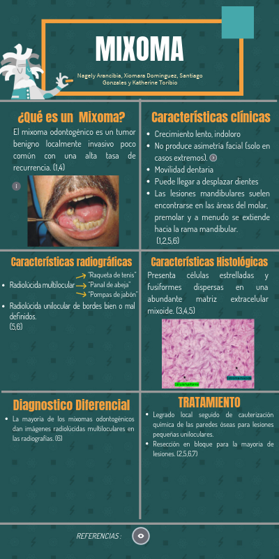 Histologia Do Mixoma Odontogenico