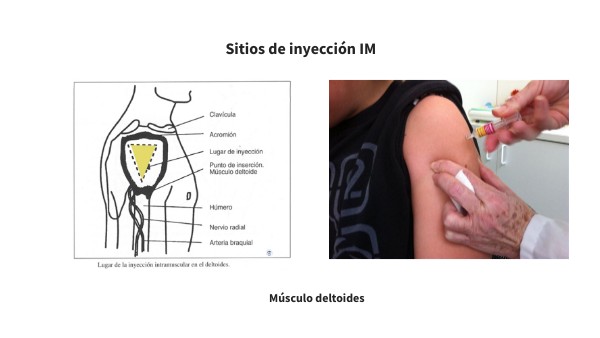 Sitios de inyección músculo deltoides