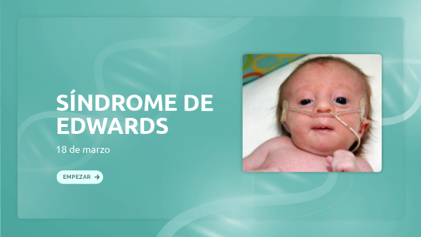Síndrome de Edwards