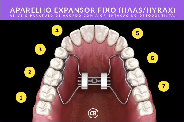Aparelho Expansor Fixo (HAAS/HYRAX)