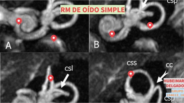 PROTOCOLOS RM OIDO SIMPLE