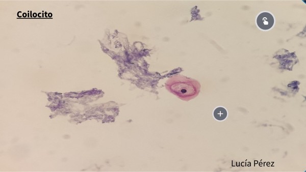 Imagen interactiva Coilocito