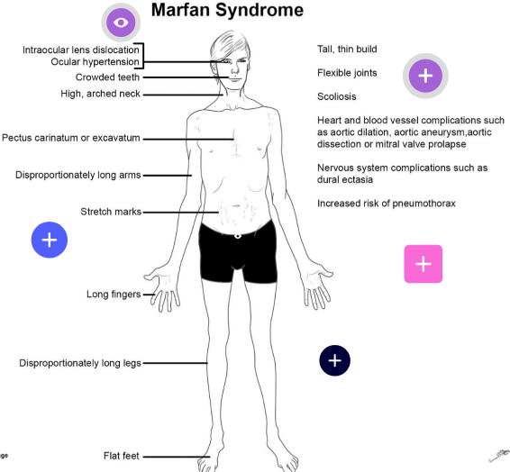 Marfan Syndrome