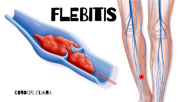 Flebitis