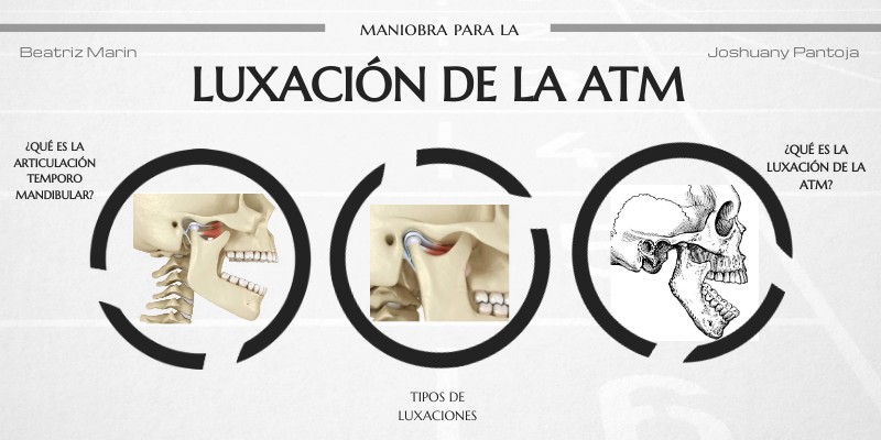 LUXACIÓN ATM