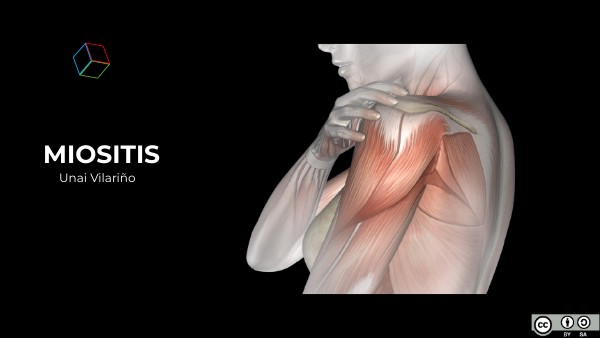 Miositis, Unai Vilariño