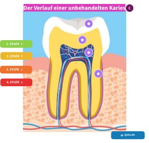 Der Verlauf von Karies