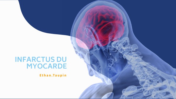 Infarctus du myocarde