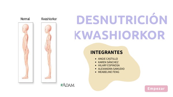Desnutrición kwashiorkor