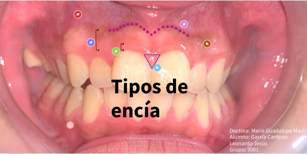 Tipos de encía