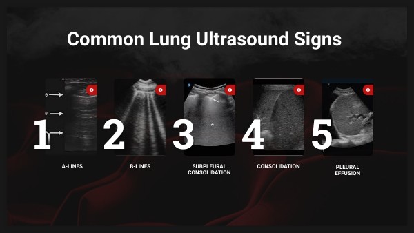 Lung Ultrasound Signs