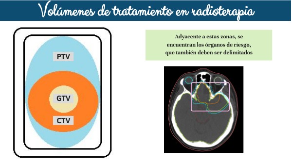 Volúmenes de tratamiento radioterapia